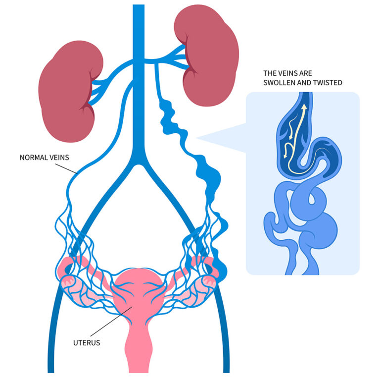 Pelvic Congestion Syndrome Treatment in Sydney
